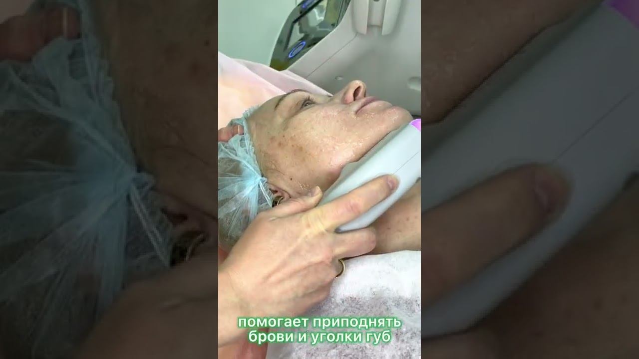 УЗ СМАС-лифтинг Дабло