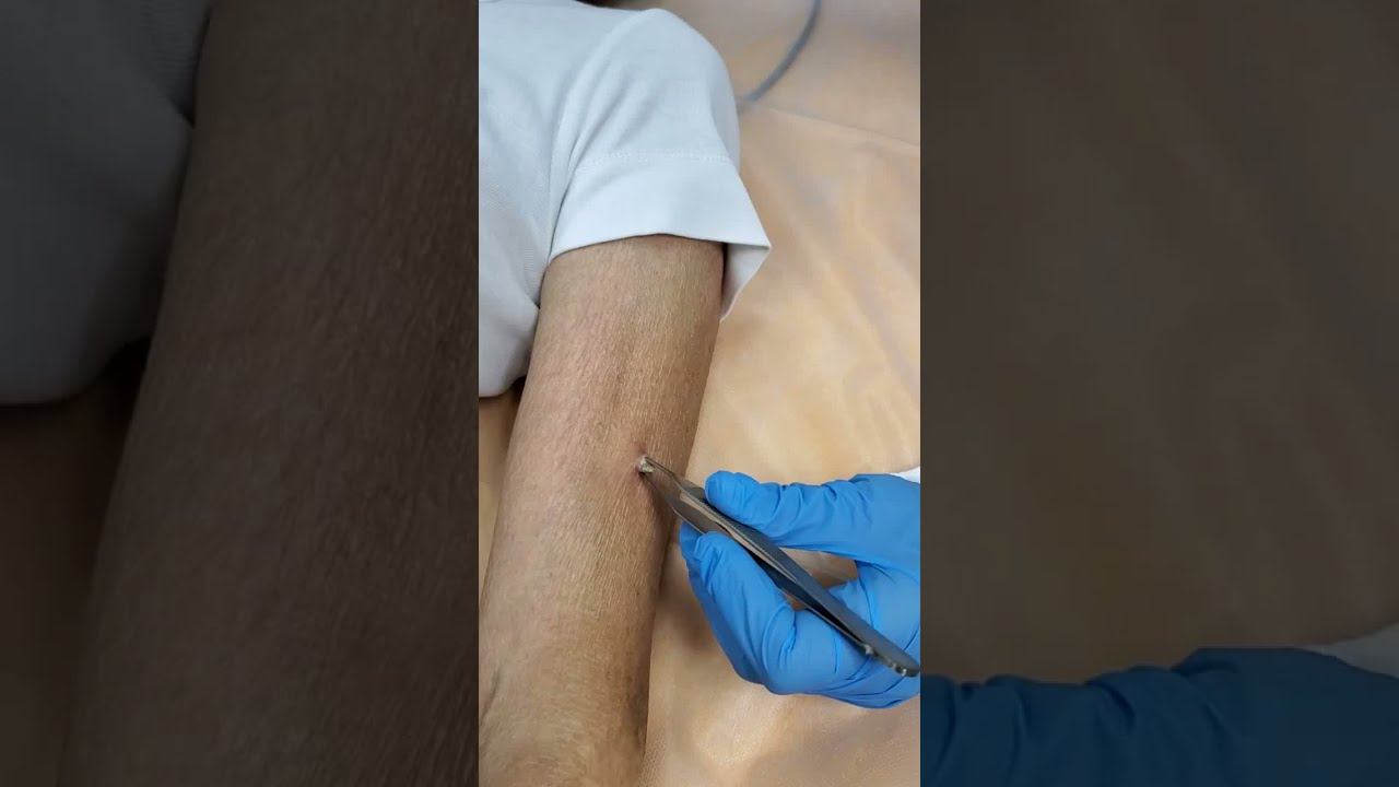 Удаление кератопапилломы