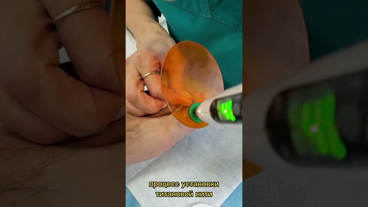 Установка титановой нити