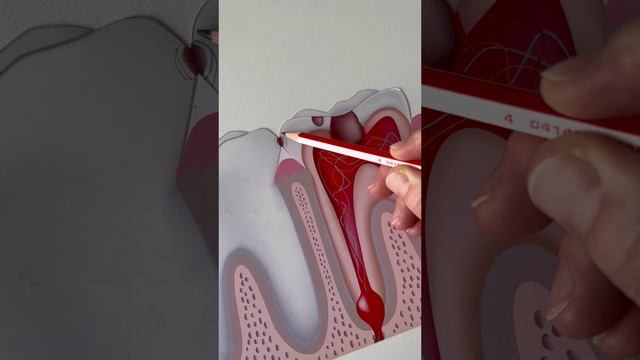 Кариес на молочных зубах