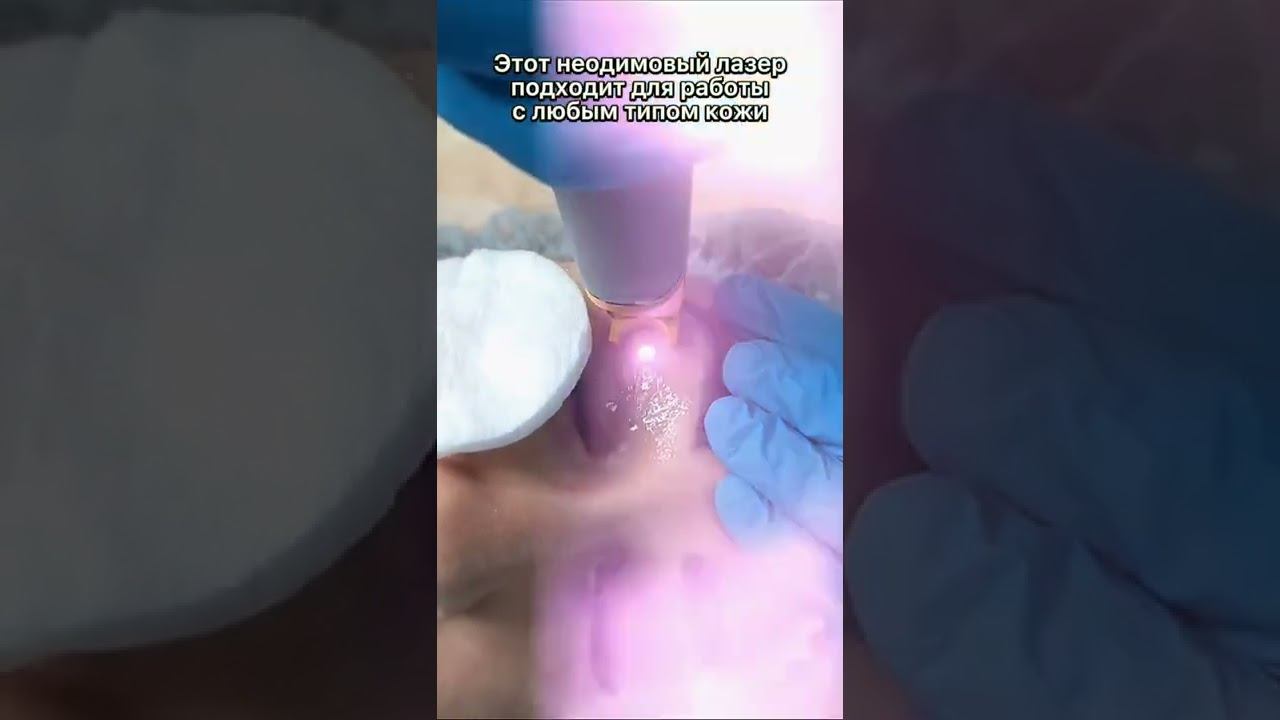 Удаление сосудов