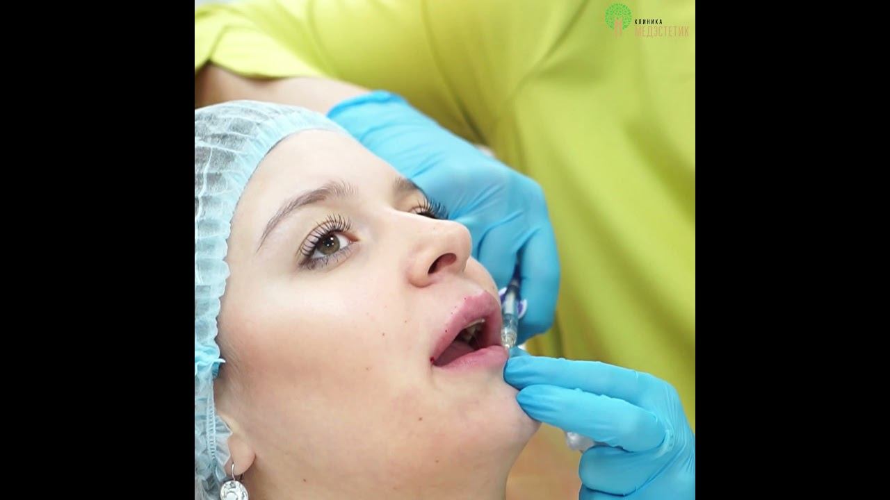 Увеличение губ Juvederm Volift
