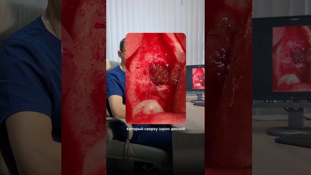 Инородные тела в лунке #школаКривошеева