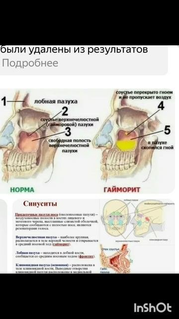 ПроЗдоровье.Операция на верхнечельстной пазухе.Фильм2.Серия4 .mp4