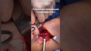 Отрыв бицепса.
