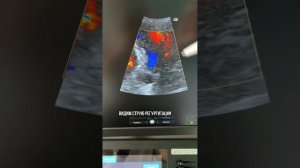 Аортальная недостаточность