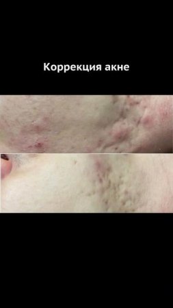 АППАРАТ, КОТОРЫЙ ЗАКРОЕТ 80% ЗАПРОСОВ ВАШИХ КЛИЕНТОВ #lasertech #lasertechcombine #бьютибизнес