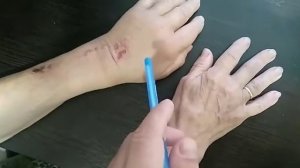 Работа с артрозом, ревматоидным артритом. Солодовникова Е. С