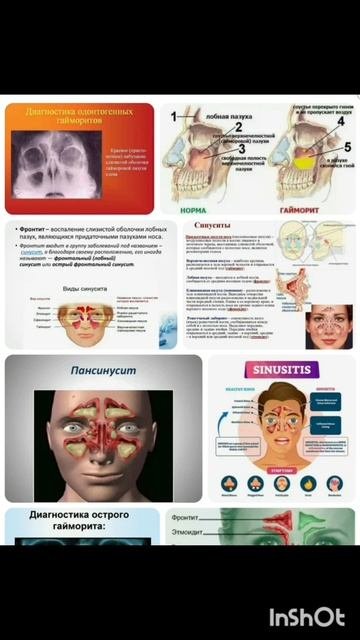 ПроЗдоровье.Операция на верхнечелюстной пазухе.Фильм1.Серия3.Часть6 .mp4