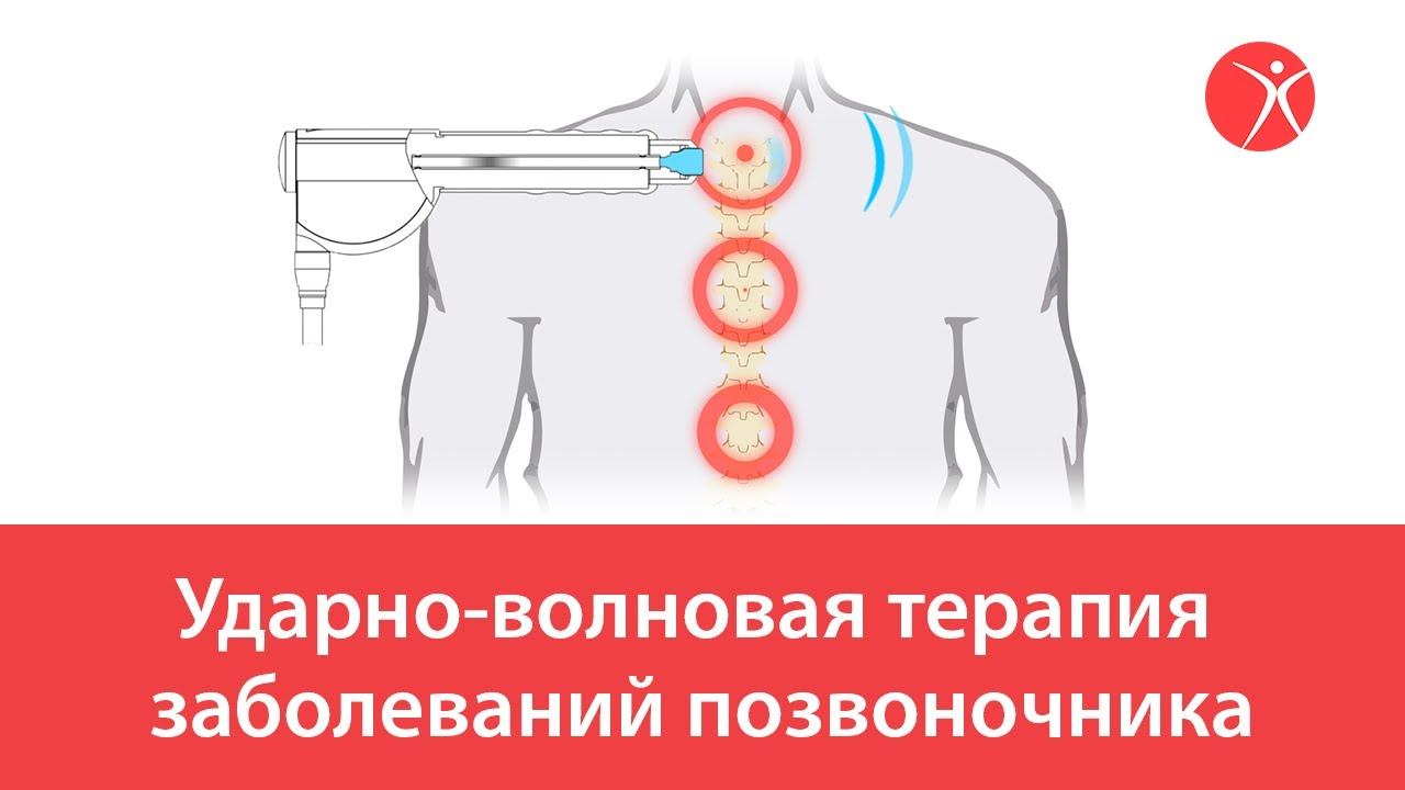 Ударно-волновая терапия заболеваний позвоночника