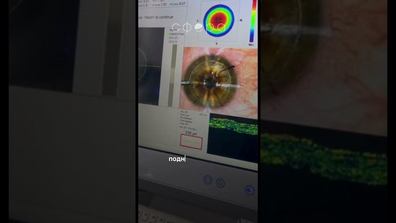 Лазерная коррекция зрения методом Femto LASIK