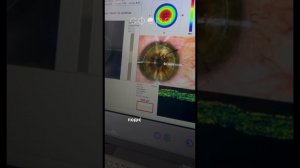 Лазерная коррекция зрения методом Femto LASIK