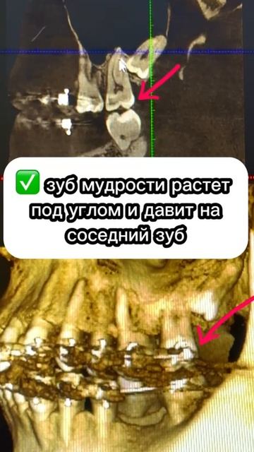 Когда нужно удалять зуб мудрости