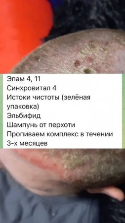 Себорейный дерматит не приговор!Псориаз, экзема-лечатся!Сила Сибирского здоровья!Siberian wellness!