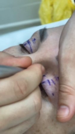 Круговая блефаропластика - разметка перед пластикой верхних и нижних век