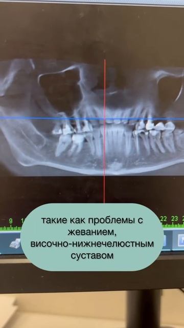 Зачем ставить брекеты на ровные зубы