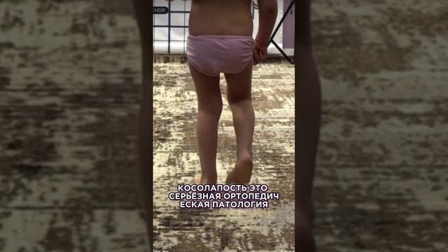 Ребёнок косолапит. Что делать?