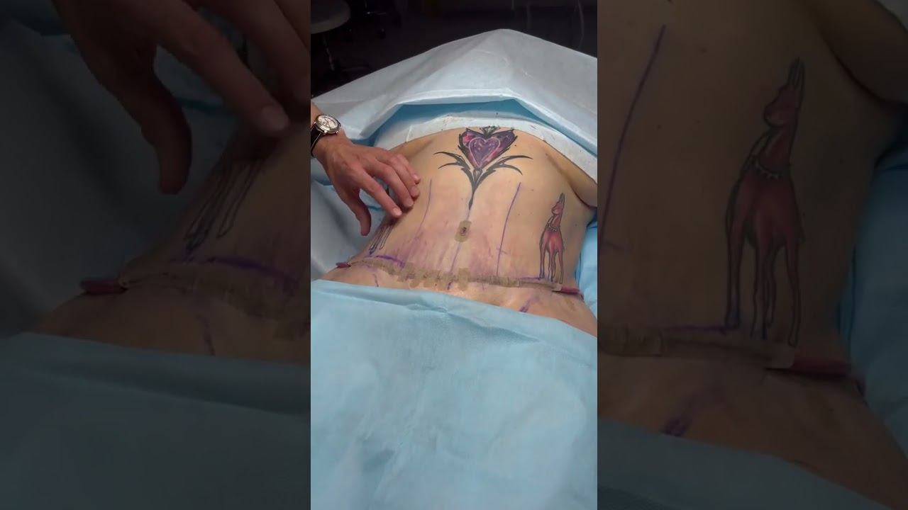 #абдоминопластика, #липосакция живота, спины, липофилинг ягодиц