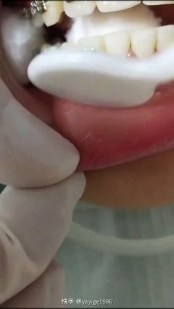 Dentist Cleaning Teeth  // Dental Cavity Filling // Dentist  // Dental Braces ..