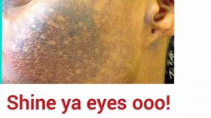 Skin bleaching! a disaster waiting to happen.