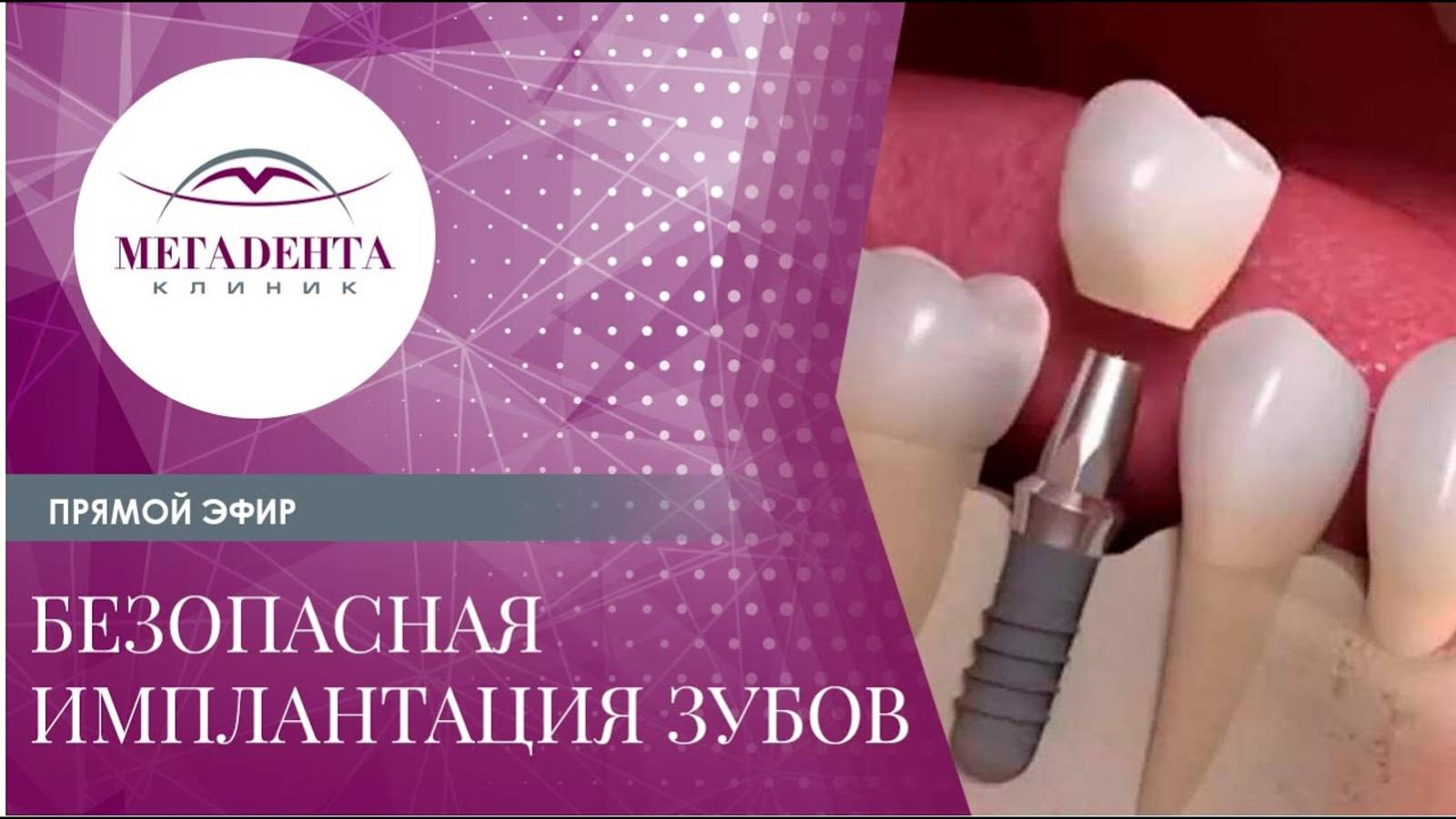 Безопасная имплантация зубов в современной стоматологии