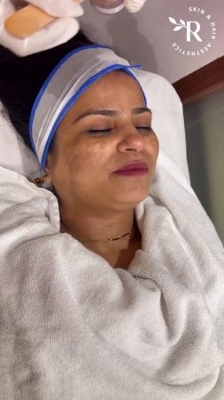 Cosmelan peel | Depigmentation Peel | Sun Damage Skin Care | RasaDerm, New Delhi | Dr. Veenu Jindal