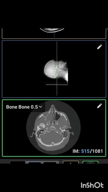 ПроЗдоровье.Операция на верхнечелюстной пазухе.Фильм1.Серия4.Часть6.mp4