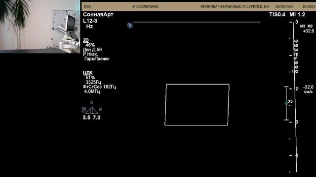 УЗИ БЦА .   68 лет курильщик, инфаркты в анамнезе.