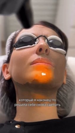 ГОЛЛИВУДСКИЙ ПИЛИНГ #косметология #карбоновыйпилинг #lasertech #косметолог #аппаратнаякосметология