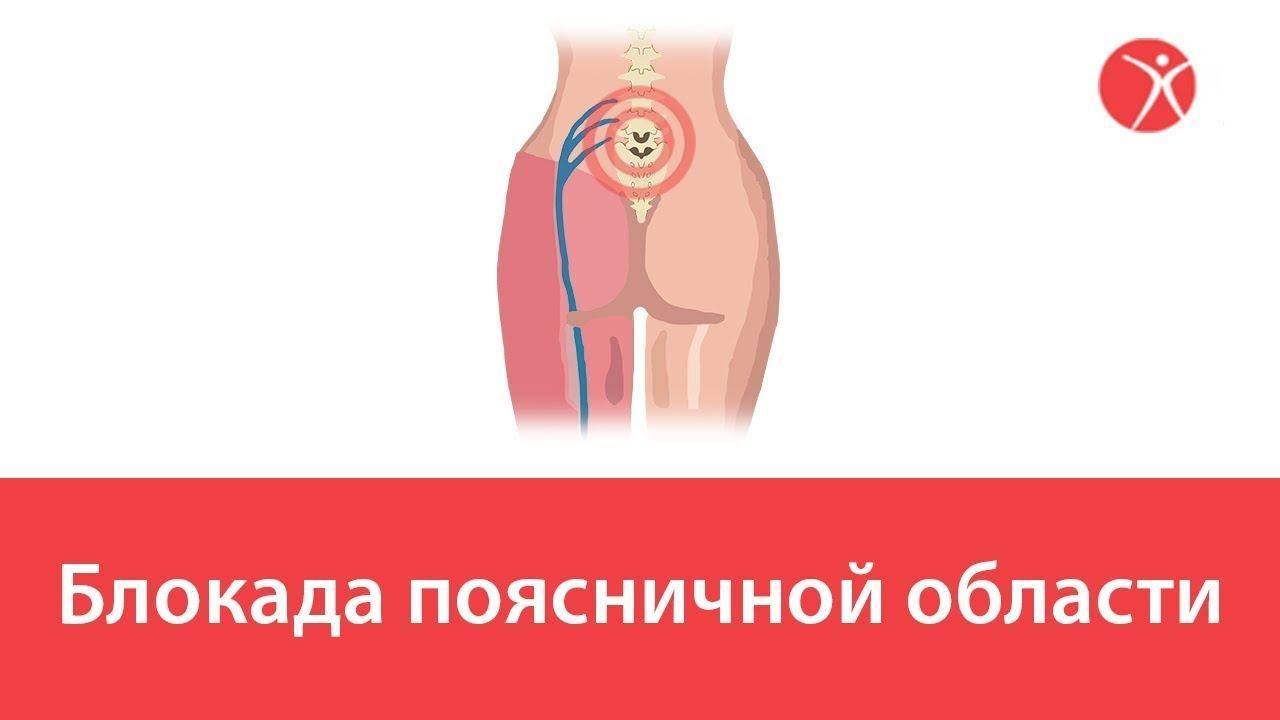 Блокада поясничной области в клинике Стопартроз
