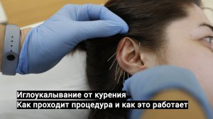 Иглоукалывание от курения — как проходит процедура и как это работает