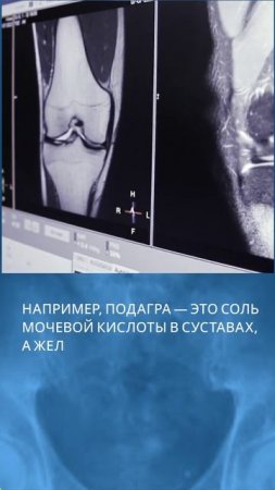 Отложение продуктов обмена и минеральных солей