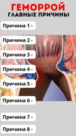 Как избежать ГЕМОРРОЯ? #меднавигатор #геморрой #прокто