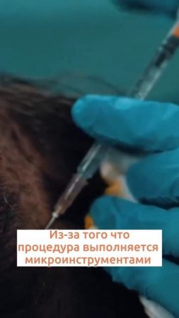 Пересадка волос без обривания! #пересадкаволосмосква