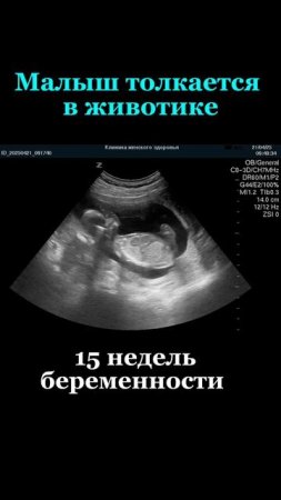 Малыш толкается у мамы в животике #shorts #беременность #узи #гинеколог