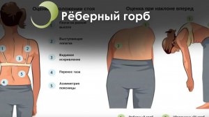 Откуда взялся реберный горб при сколиозе и почему бесполезно с ним работать_