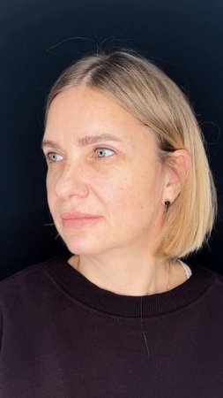 Пластика век - результат пластической операции спустя 3 недели