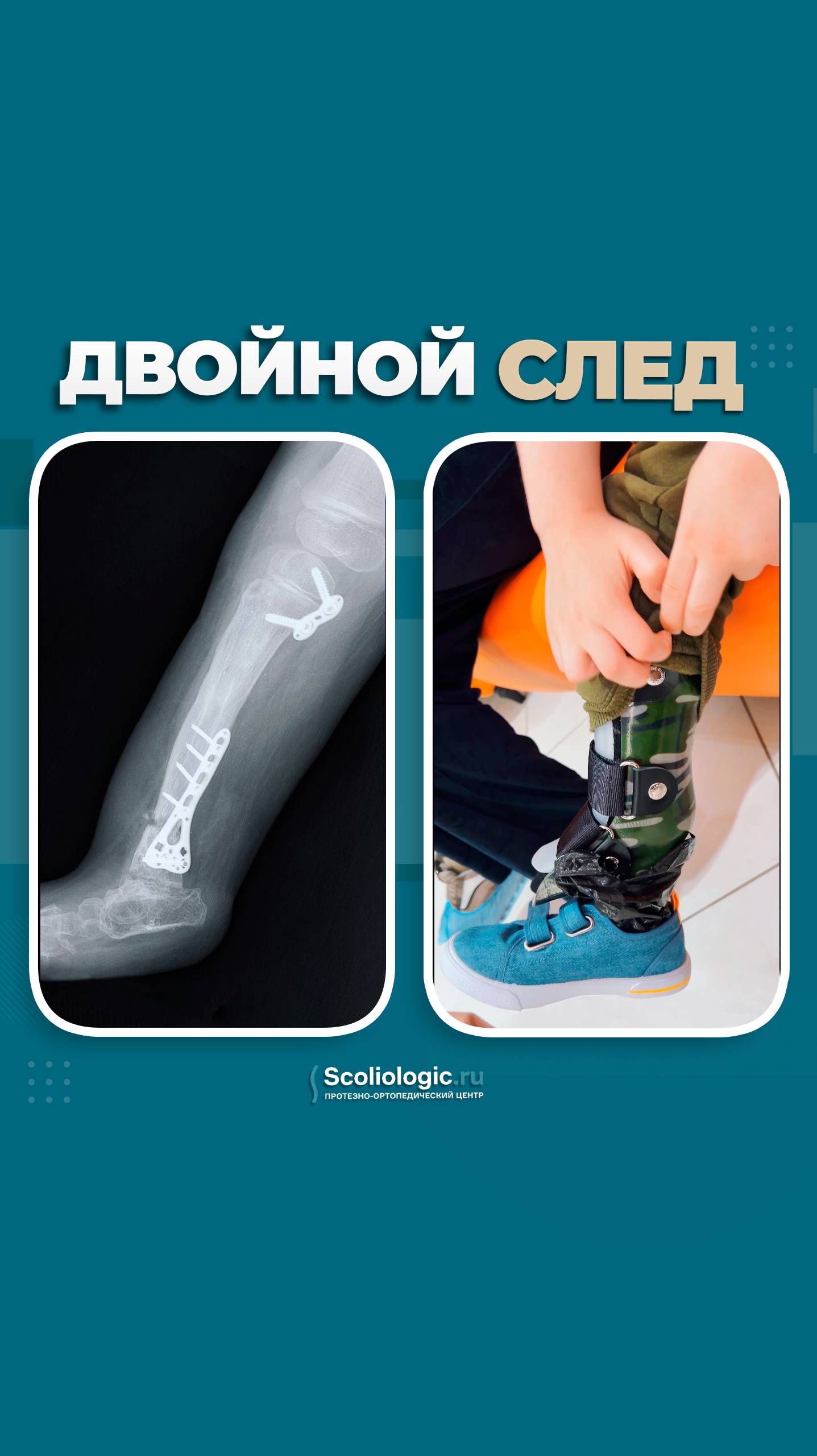 Протез с двойным следом для ребенка