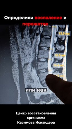 Забитый кишечник, воспаление, пережатие #польза #здоровье #лечение