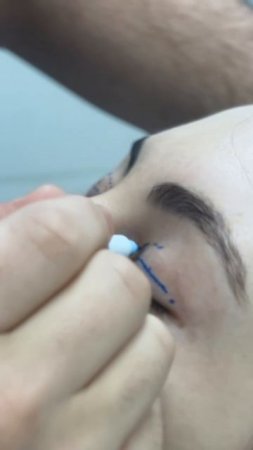 Круговая блефаропластика - профессиональная разметка перед пластикой верхних и нижних век