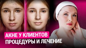Процедуры против АКНЕ | Лучшие стратегии коррекции и домашний уход | Протоколы, которые РАБОТАЮТ!