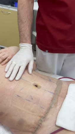 #липосакция и #абдоминопластика: первые сутки после операции