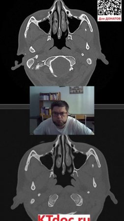 Расшифровка КТ и МРТ #mentor #ct #кт #наставник #ктдок
#мрт #mri #mentor #наставник  #ktdoc #ктдок