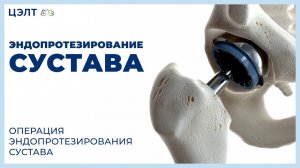 😷 Эндопротезирование сустава. Операция эндопротезирования сустава. ЦЭЛТ.
