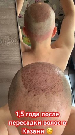 Пересадка волос в Казани, оно того стоило？ 1,5 года после операции от ДО и ПОСЛЕ! - ТЕХНОХОУМ_ТЕХНИК