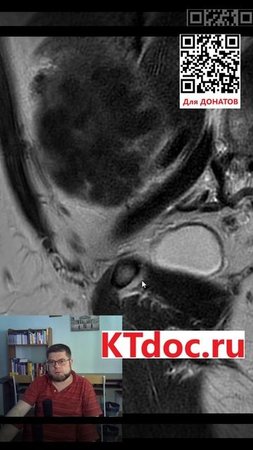 Миома матки на МРТ #mentor #ct #кт #наставник #мрт #mri #mentor #наставник  #ktdoc #ктдок