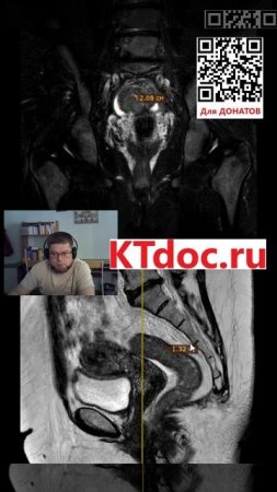 Опухоль кишки на МРТ #mentor #ct #кт #наставник #мрт #mri #mentor #наставник  #ktdoc #ктдок