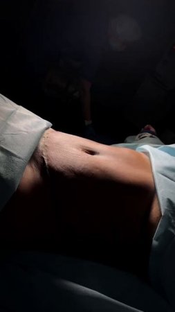Пластика живота для девушки из Калифорнии - результат сразу на операционном столе