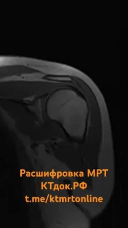 Расшифровка МРТ. Плечевой сустав
