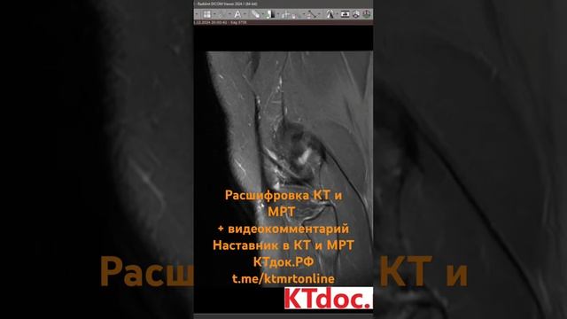 Расшифровка МРТ. Коленный сустав